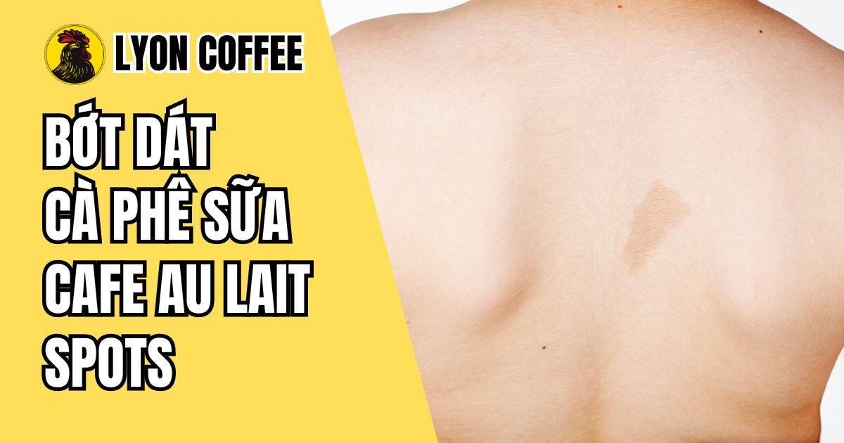 Bớt dát cà phê sữa Cafe Au Lait Spots - Cách điều trị bệnh